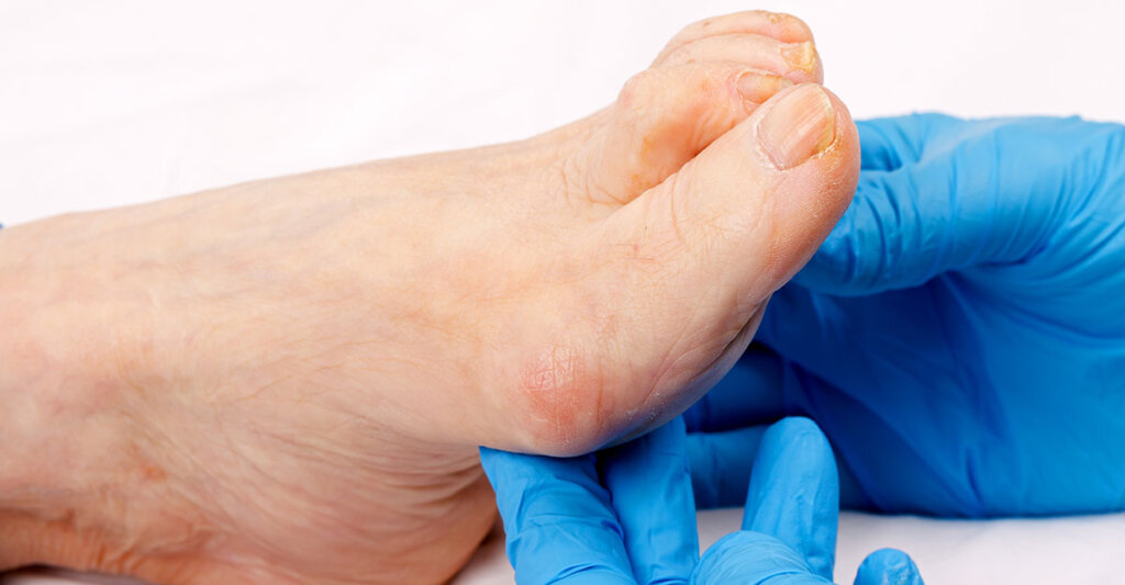 What Is Charcot Foot? | WCEI WCEI