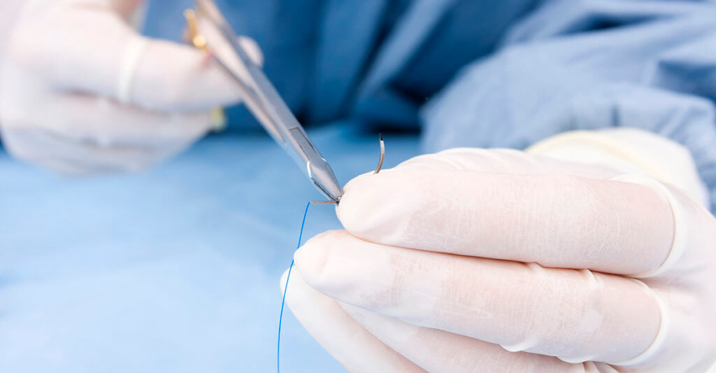 3 Types of Wound Closure and What They Mean WCEI